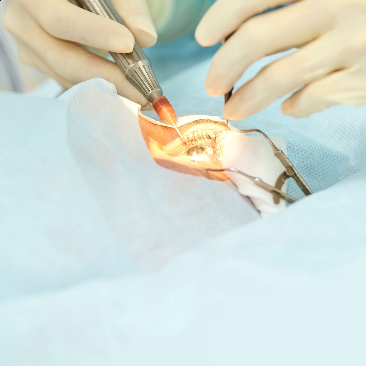 10 Reasons to Consider Refractive Surgery | by Dr. Akbar Super ...