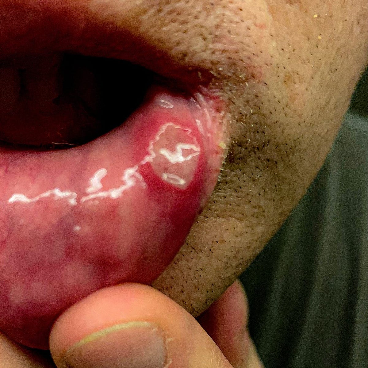 My fight against Aphthous ulcers. First of all I´m not a doctor or an ...