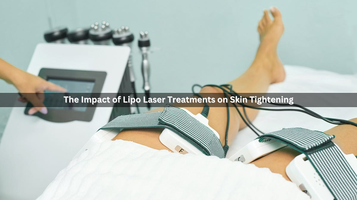 The Impact of Lipo Laser Treatments on Skin Tightening | by myChway UK ...