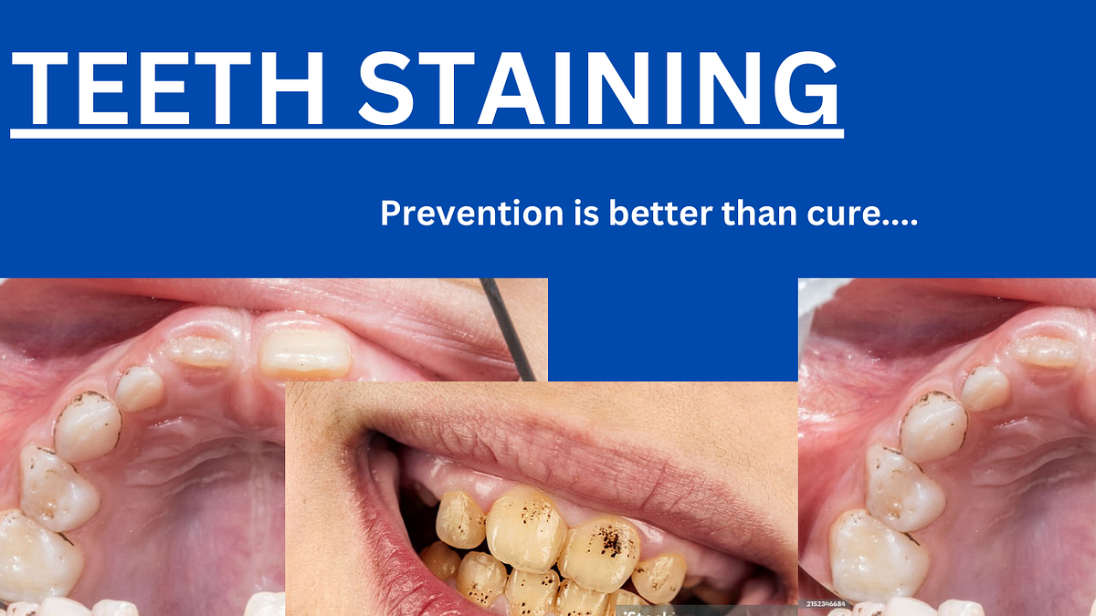 What Drinks Stain Teeth the Most? Causes, Treatment Remedies, and ...