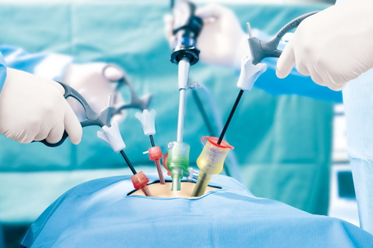 What Is Laparoscopic Surgery?. Laparoscopy is a kind of surgery that ...