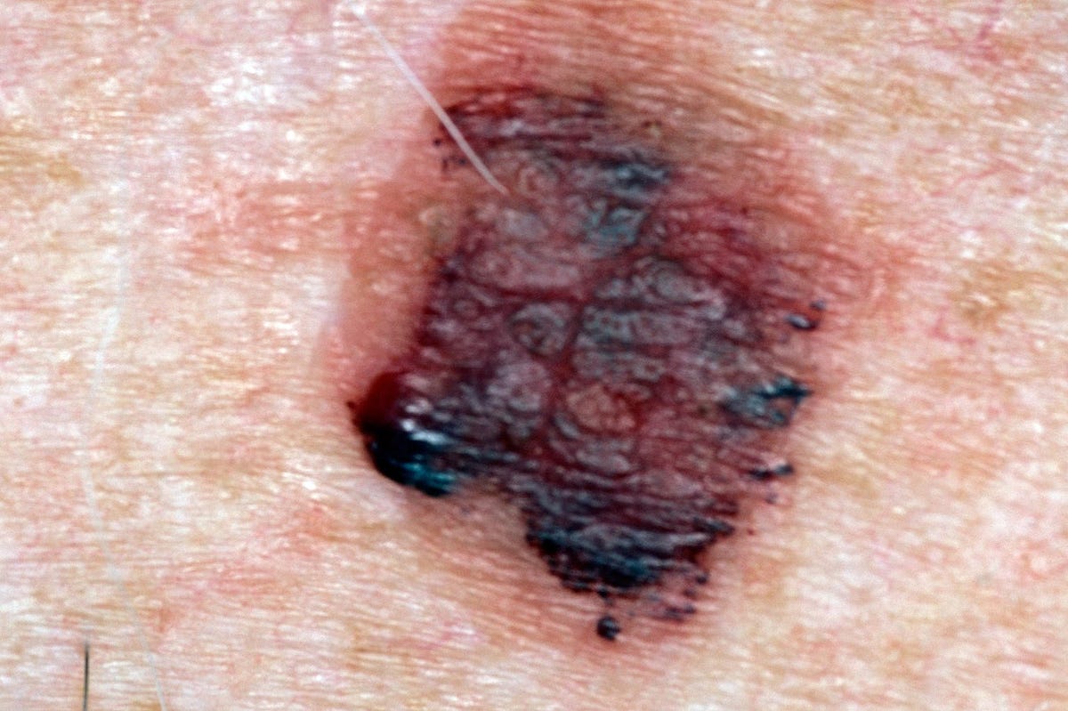 Skin Cancers in India. By Neeti Goutam, Sanrachana | by Sanrachna ...