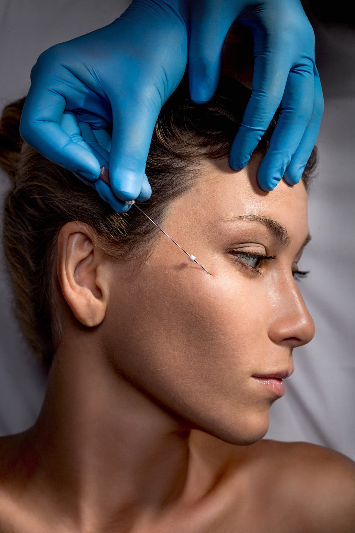 What is The Use of A Silhouette Thread Lift? | by Este Medical Group ...