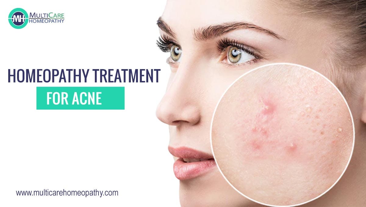 Is homeopathy treatment good for acne? | by Multicare Homeopathy | Medium