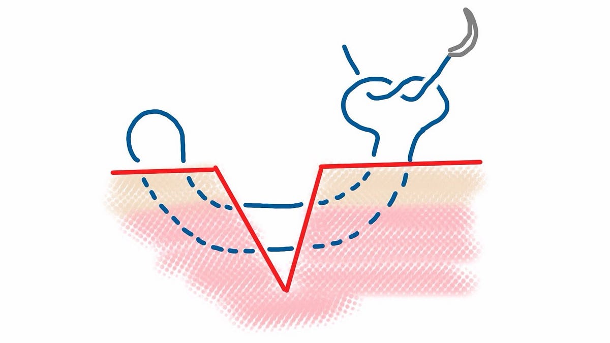 Covered even sleeping pad suture. A dermal-subdermal suture includes ...