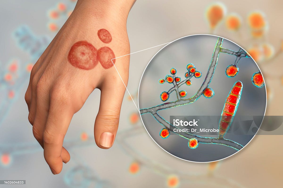 Sexually Transmitted Ringworm in NYC? Shocking Facts😱 You Can’t Ignore ...