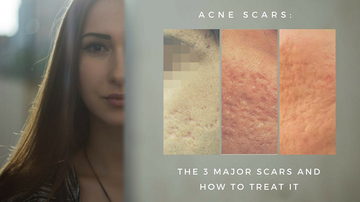 Acne Scars: The 3 Major Scars and How to Treat it | by Martin Connor ...