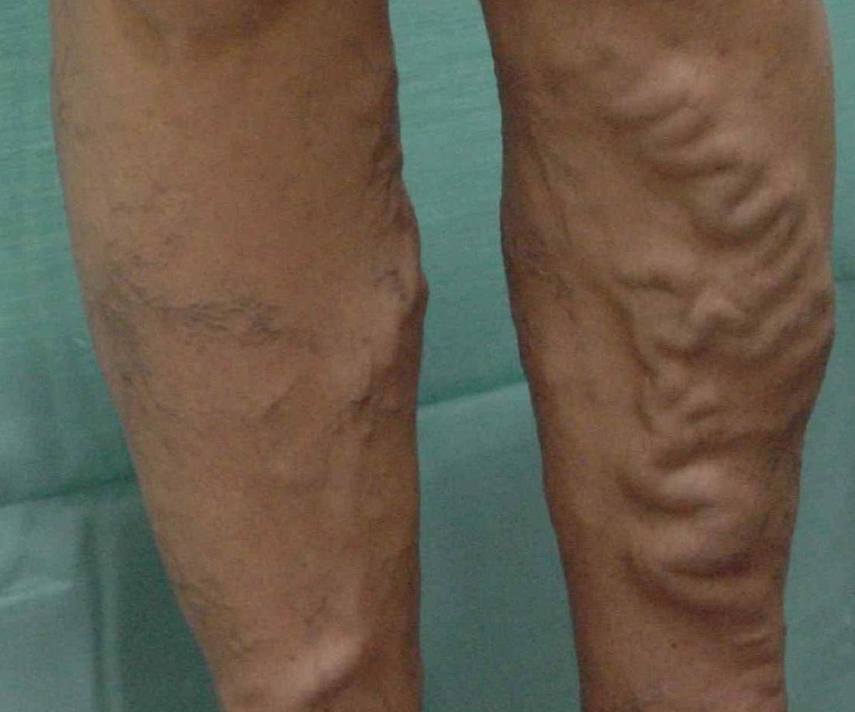 Tipos de varices. Existen diferentes tipos de varices y… | by Varices10 ...