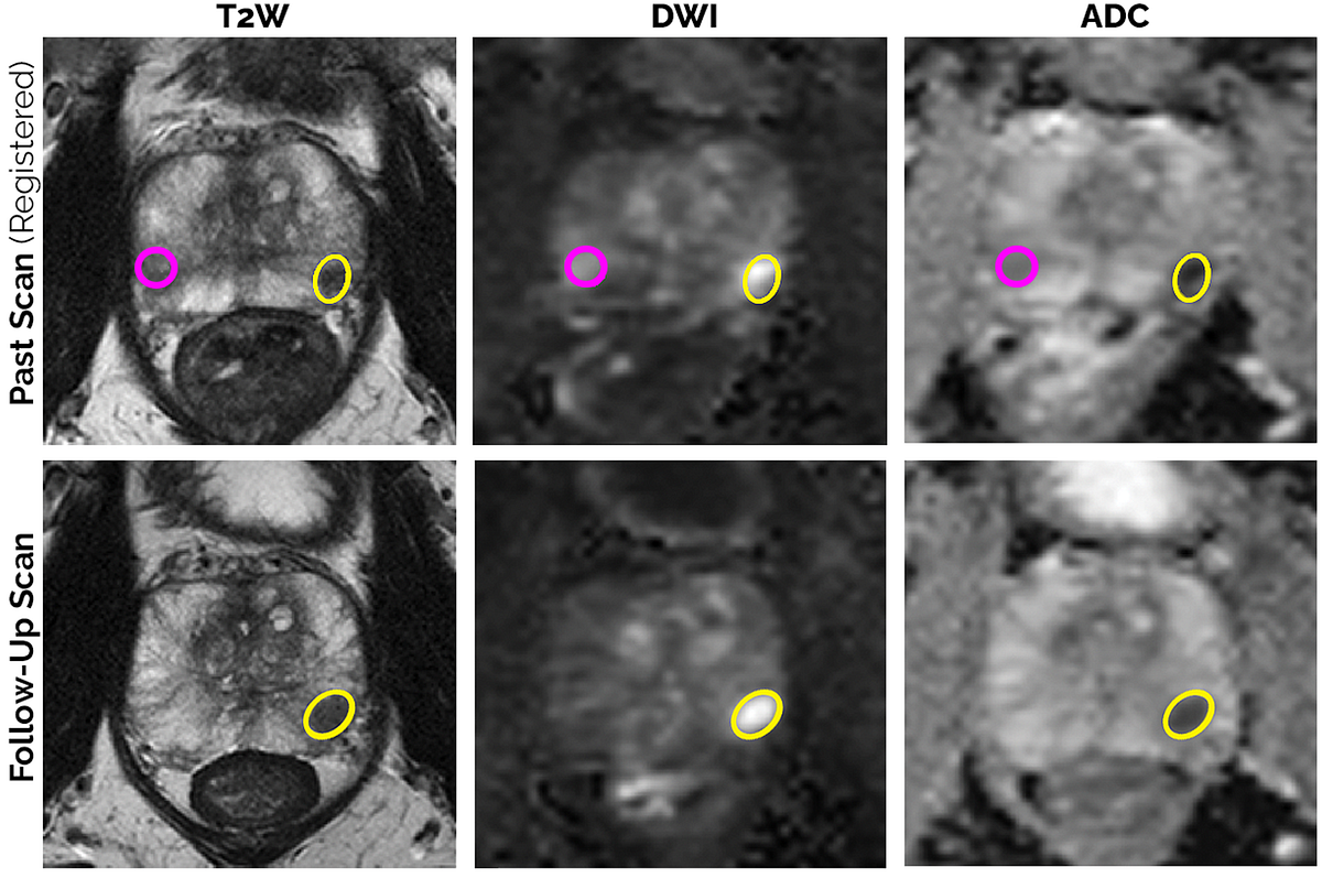 Developing Ai For Clinically Significant Prostate Cancer Diagnosis In Radiology By Anindo Saha