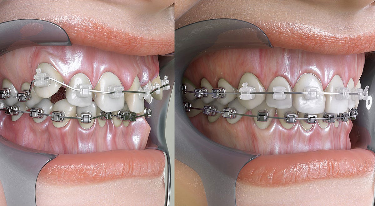 Braces are painful — here’s why. Authored by Minahil Syed | by Ora-3D | Medium