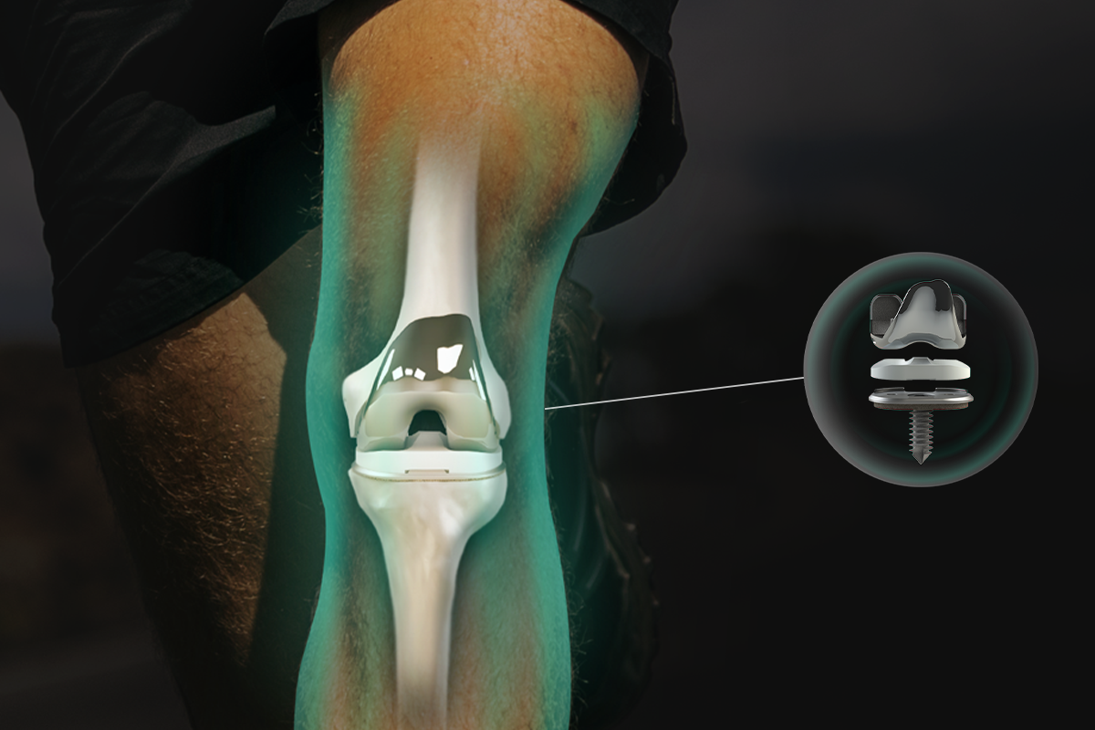 The Future of Joint Replacement Surgery: Enhanced Techniques ...