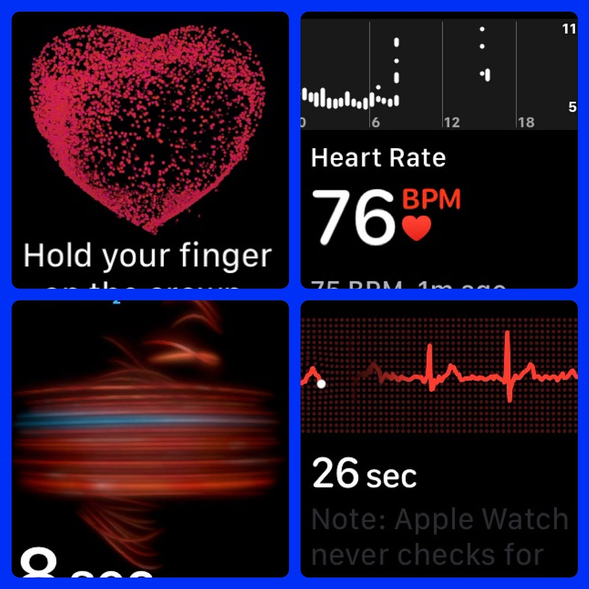 ME/CFS & FMS: Heart Symptoms. Palpitations, POTS, Pain, Orthostatic ...