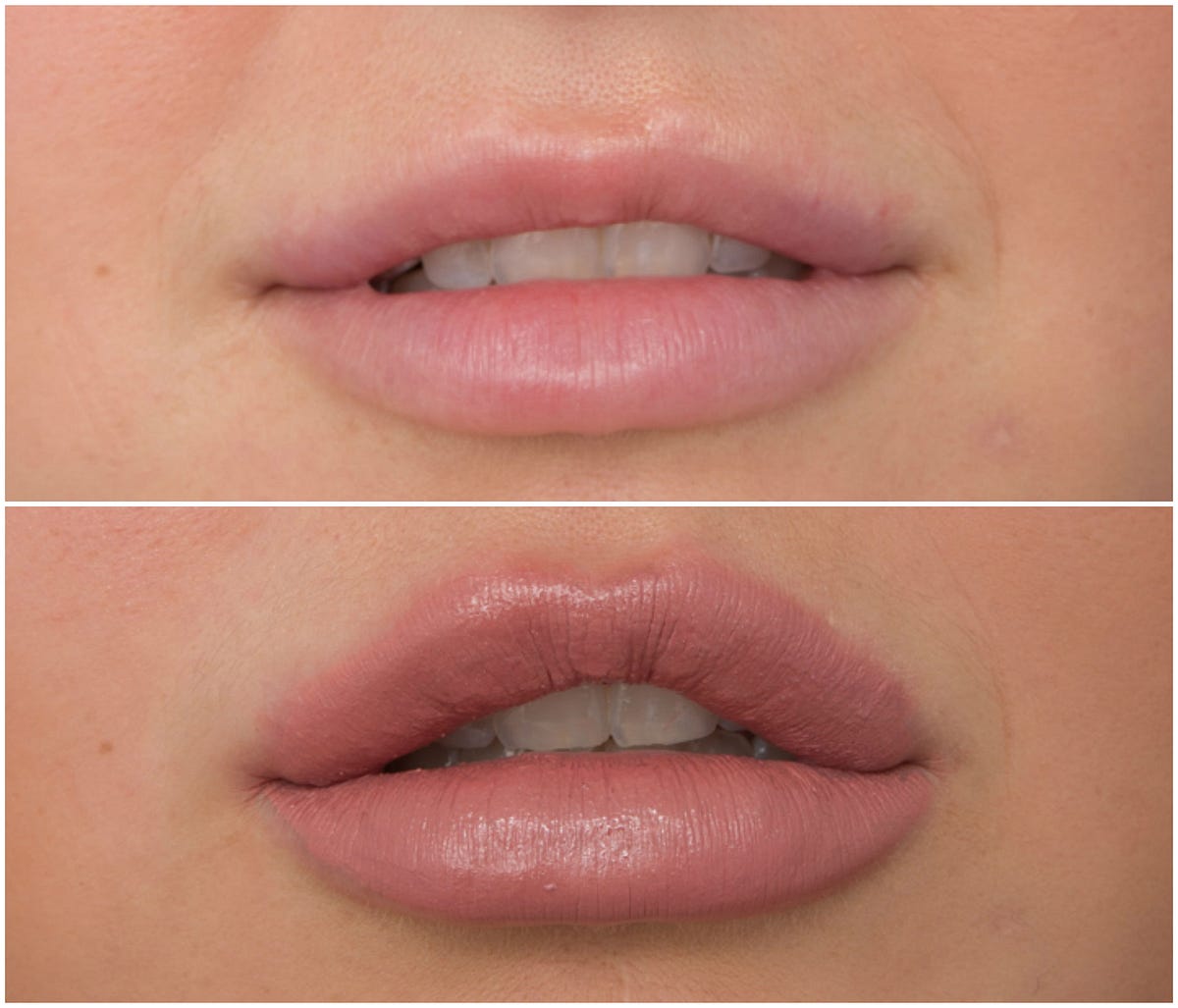 Cosmetic Surgeon Dr. Randal Haworth on Lip Augmentation: How To Achieve ...