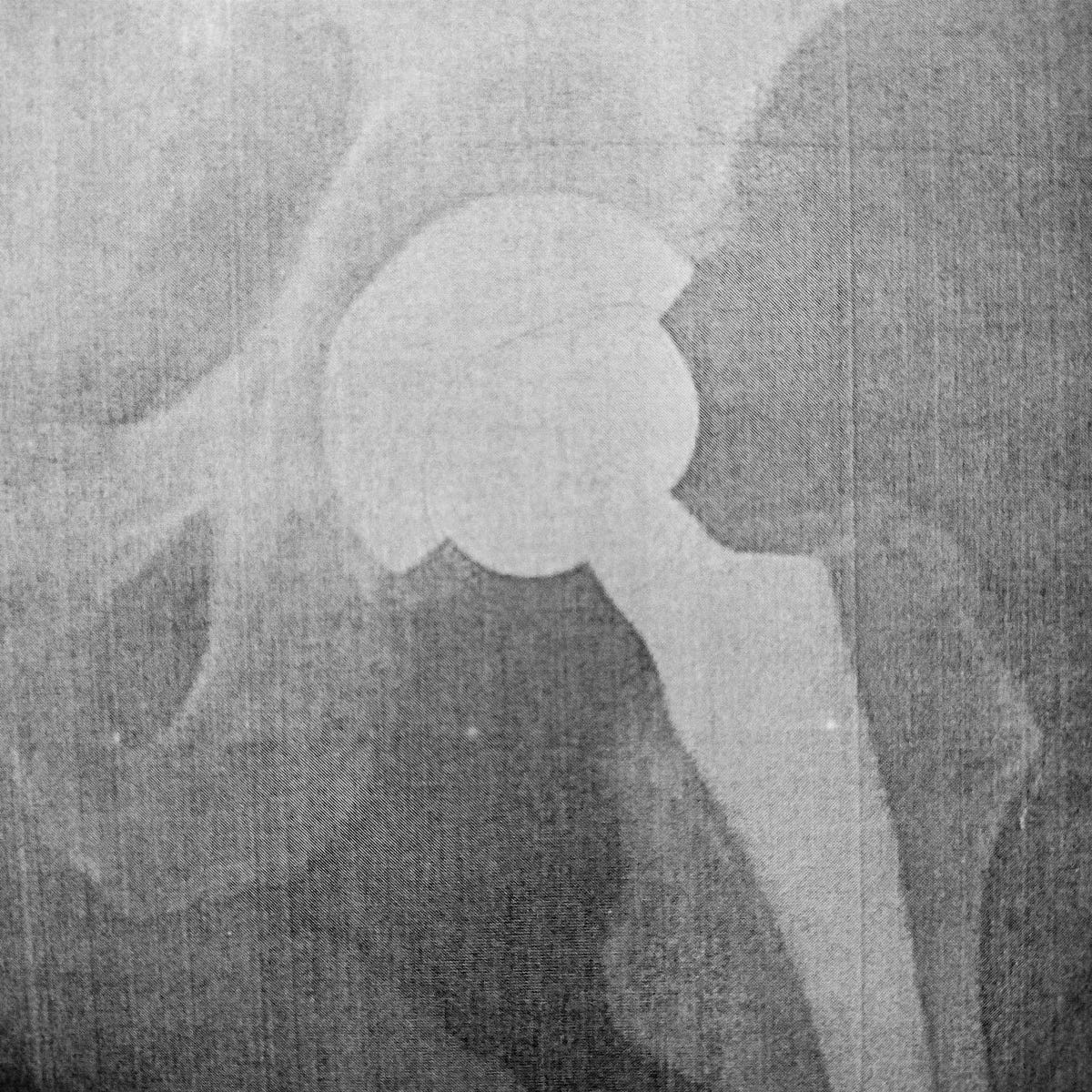 Lessons Learnt from a Hip Replacement | by Lisa Jones | Never Stop ...