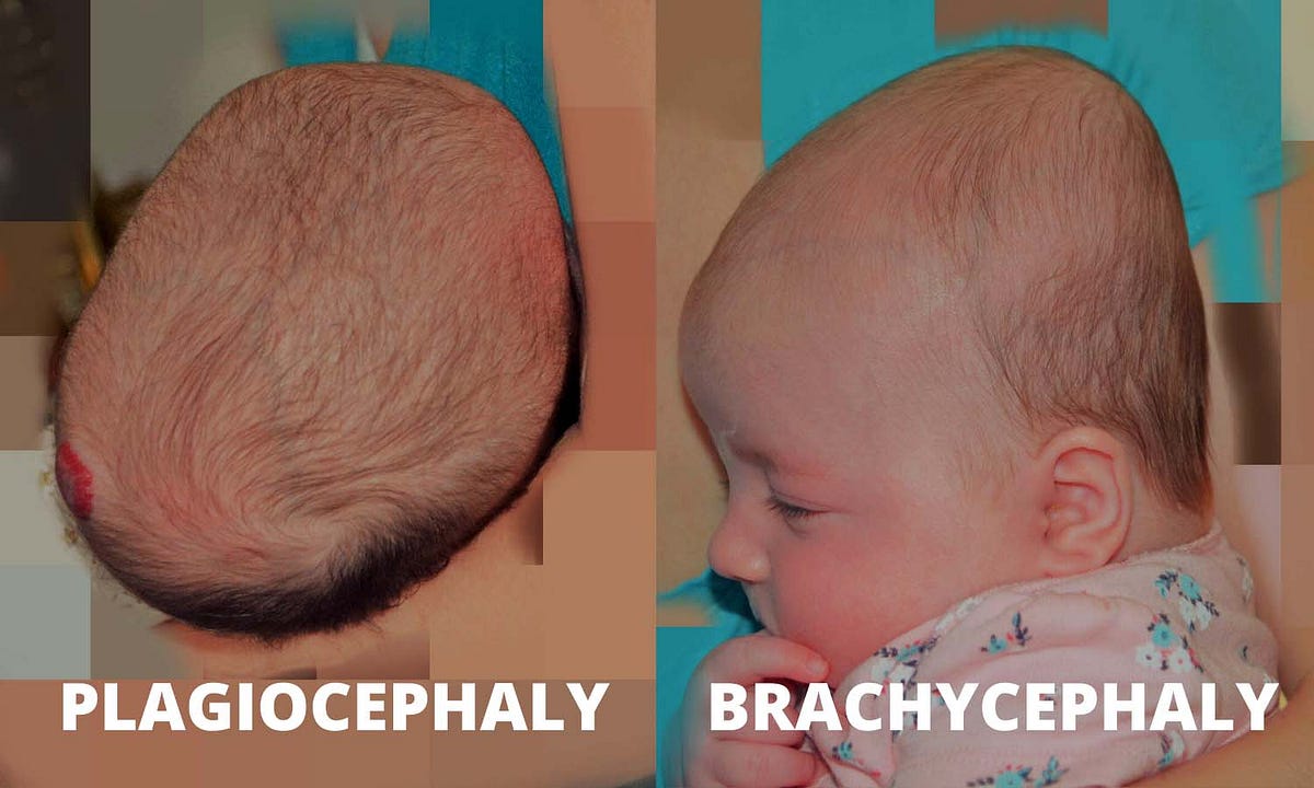 How long does it typically take for a newborn’s head shape to normalize ...