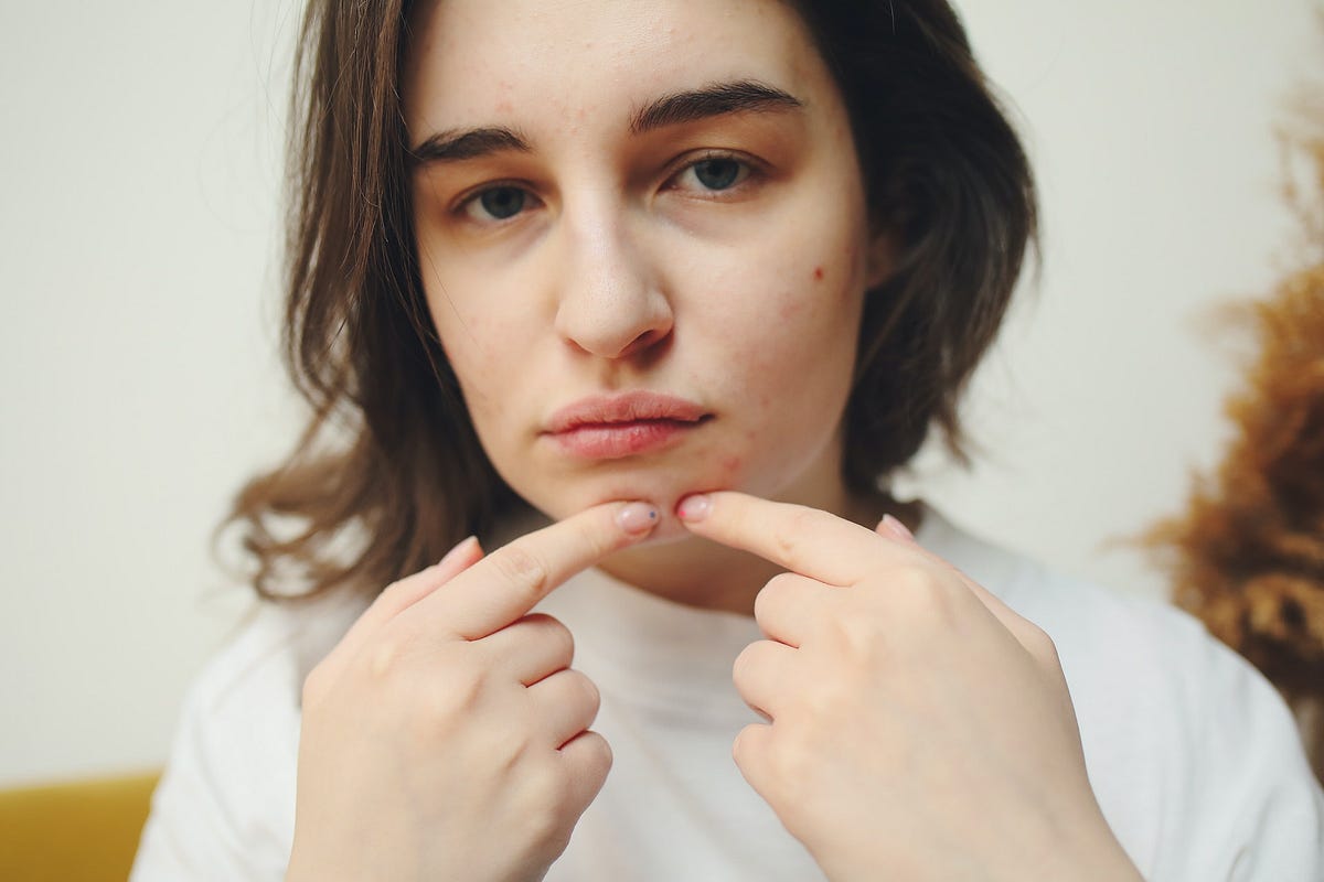 From Ugly to Flawless: The Dermatologist’s Guide to Popping Pimples ...