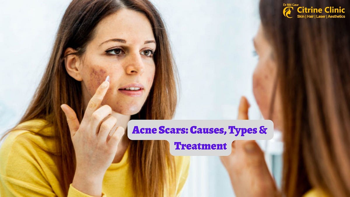 Acne Scars: Causes, Types & Treatment | by Isha Sharma | Medium