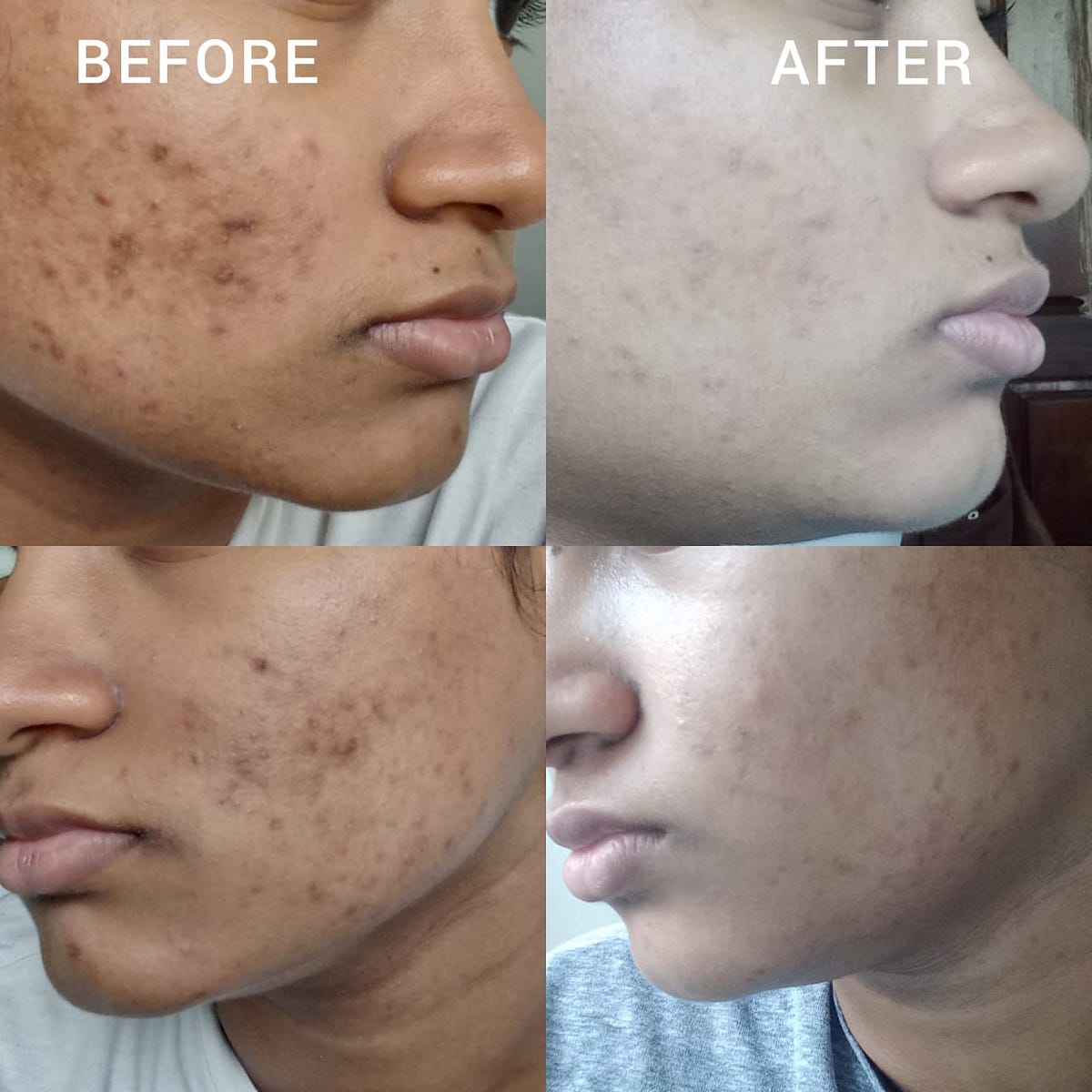 My Skin Care Journey: How I Finally Healed My Acne Scars and Found ...