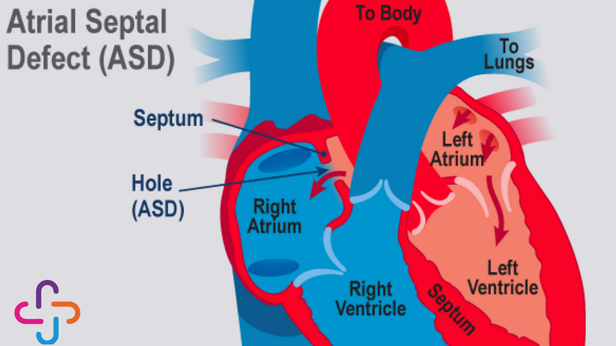 Best Possible Methods For Atrial Septal Defect Asd Repairs By Prasanthvs Medium