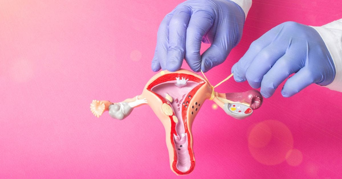 Facts You Should Know Before Tubectomy: Tubal Ligation | by Dr Shefali ...