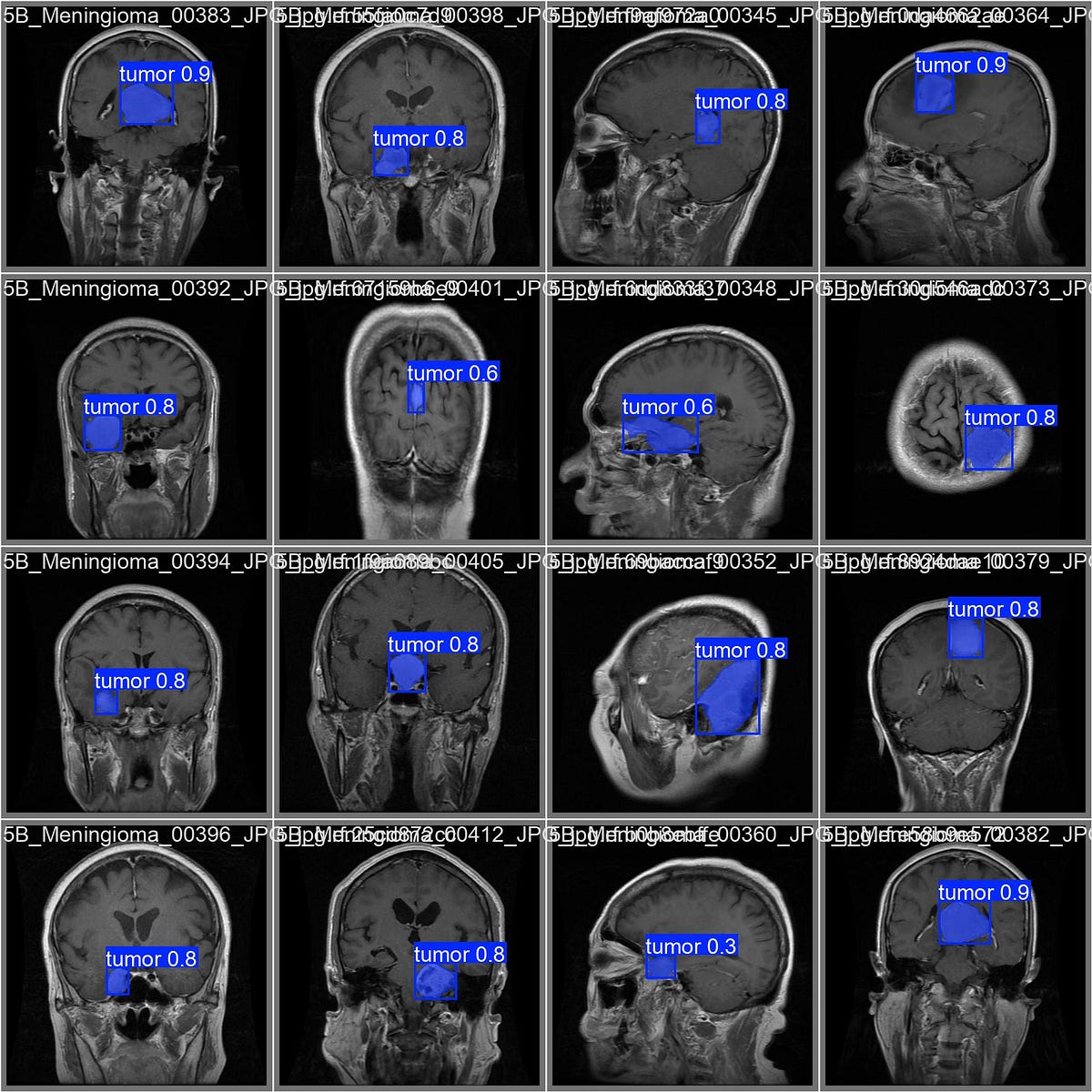 Revolutionizing Tumor Detection with AI: A New Era for Medical Imaging ...