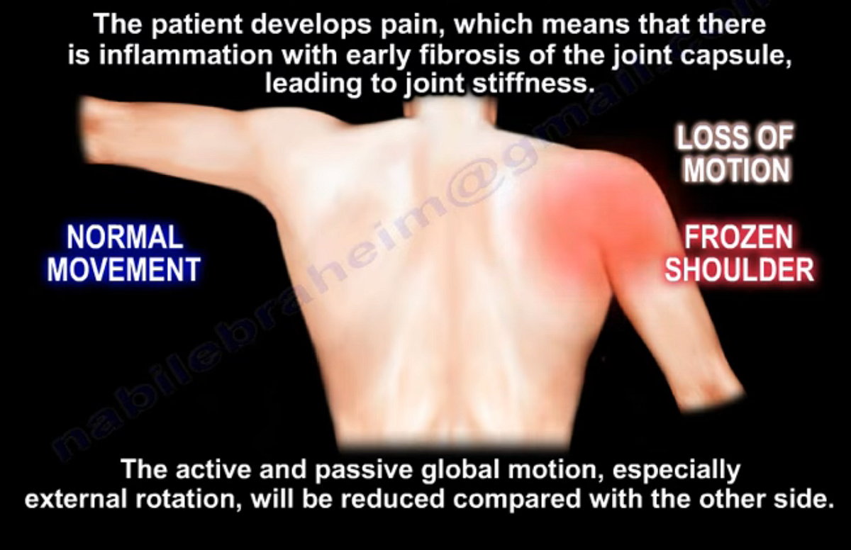 Frozen Shoulder: Causes, Diagnosis, and Treatment | by Nabil Ebraheim ...