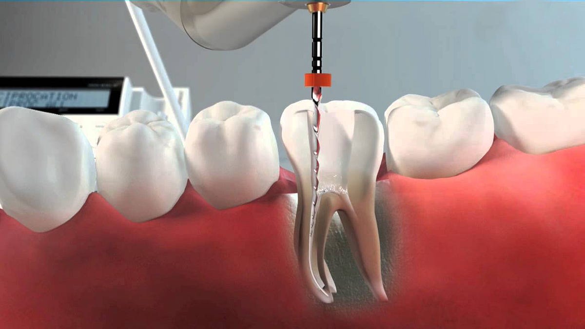 Beyond Initial Treatment: What You Need to Know About Re-Root Canal in ...