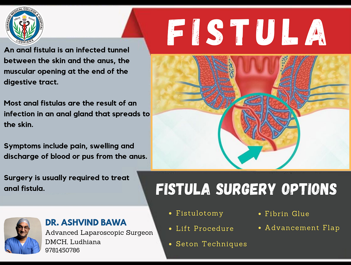 Fistula Treatments. The anal fistula (also commonly called… | by Dr ...