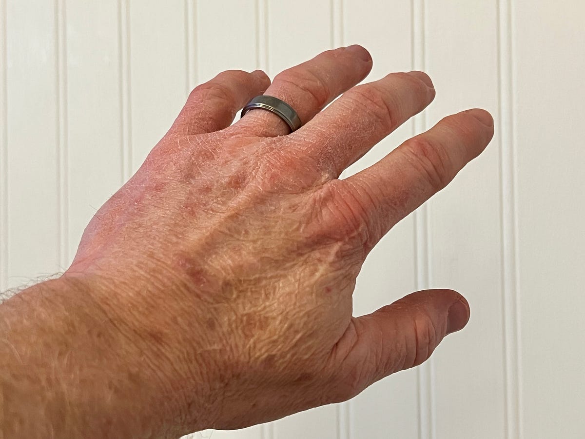 Too afraid to show my hands — overcoming the fear of letting others see ...