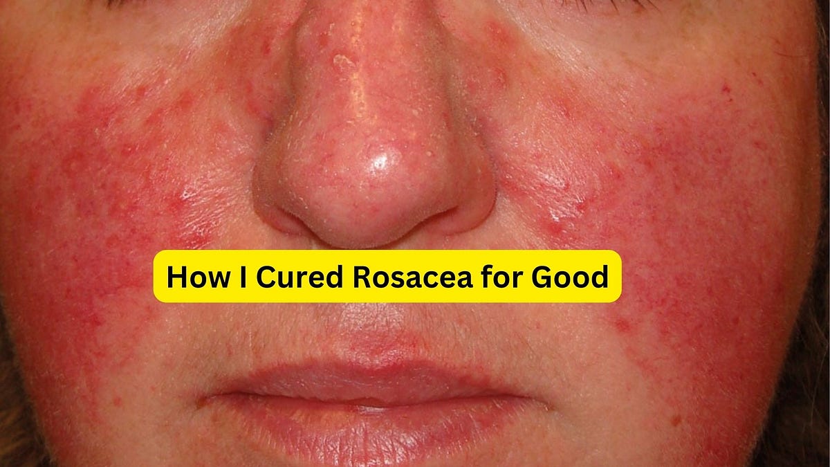 How I Cured Rosacea for Good: Discover the Secrets to Clear and Healthy ...