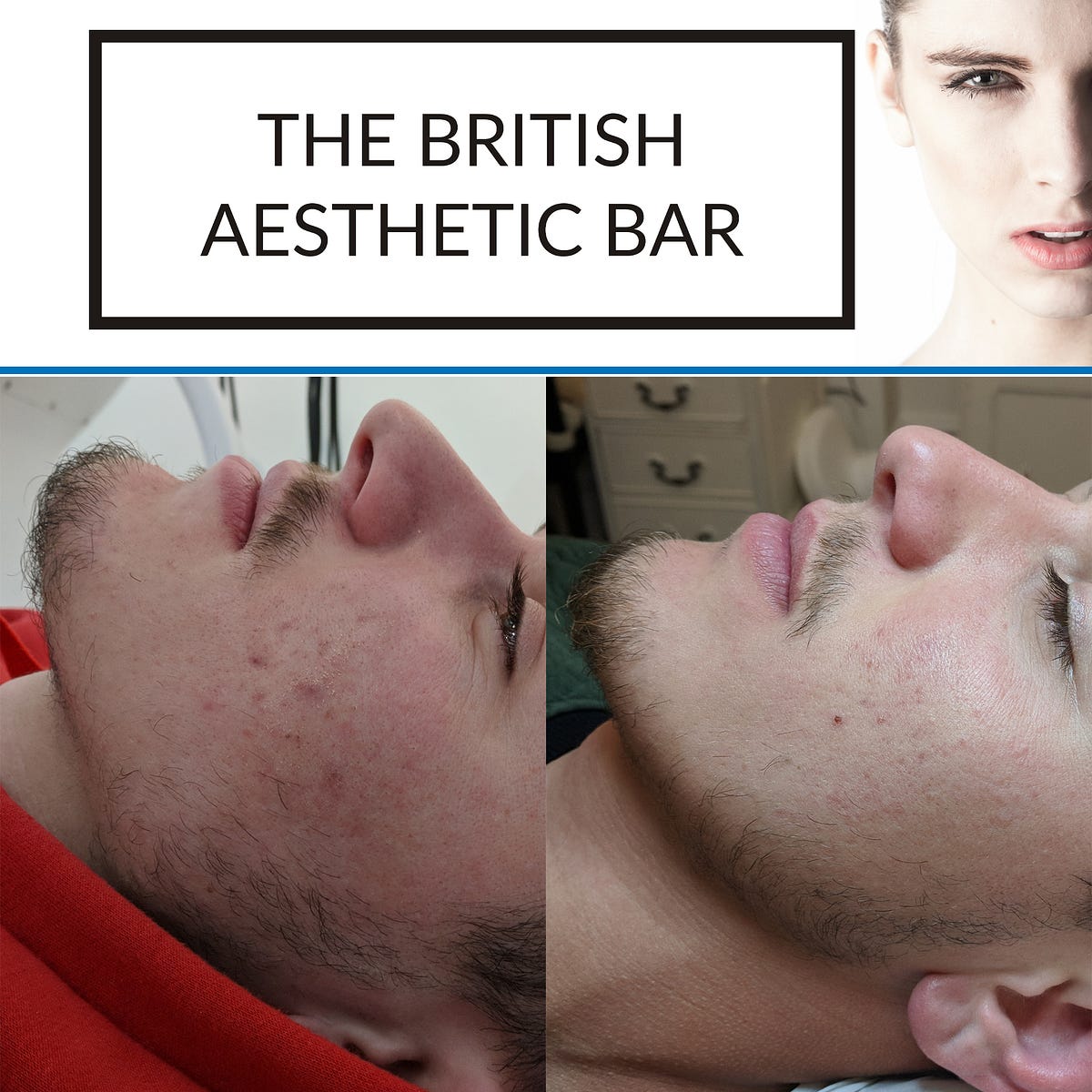 Chemical Peels- Types. AlumierMD Chemical Peels | by The British ...