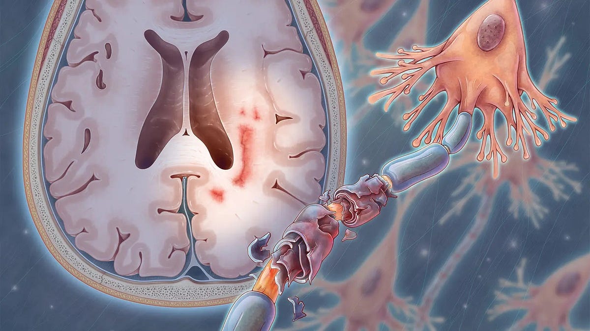 INSIGHT into Multiple Sclerosis: Chapter 1: What is MS? | by DrRany ...