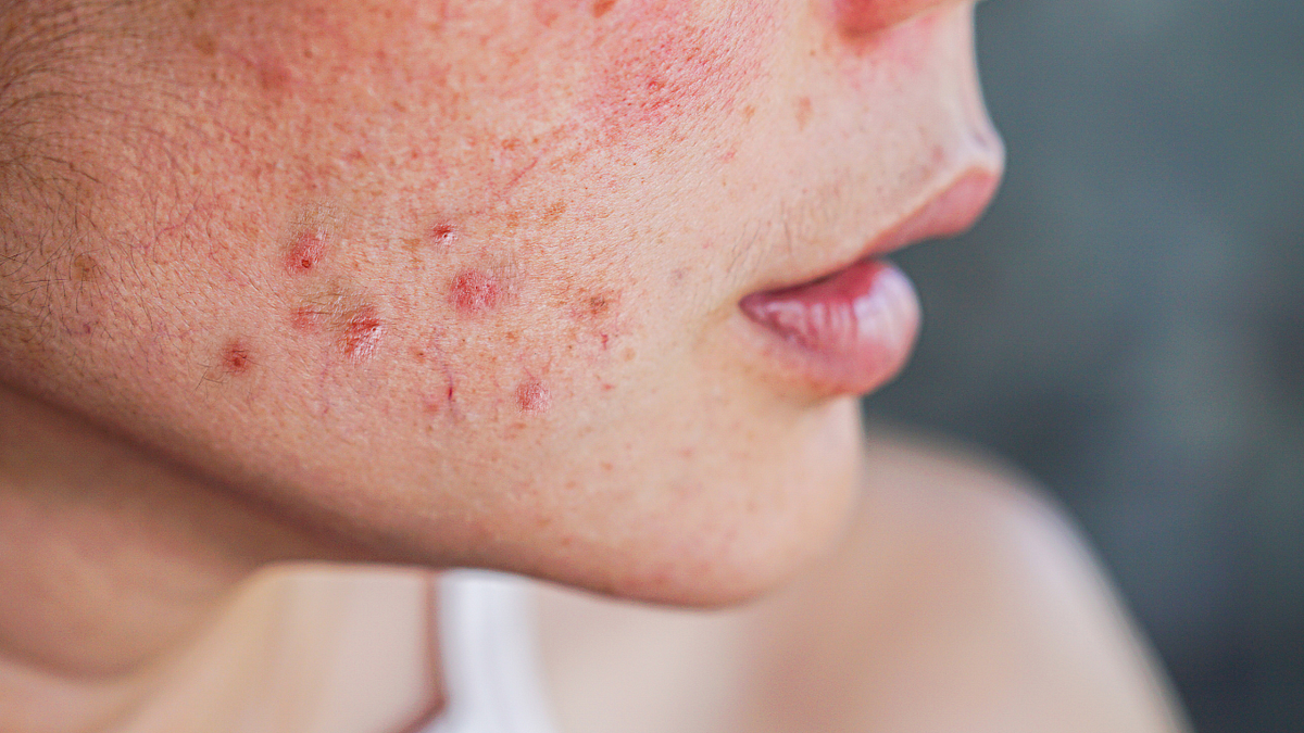 Effective Acne Control Methods — Your Clear Skin Guide | by Vitality ...