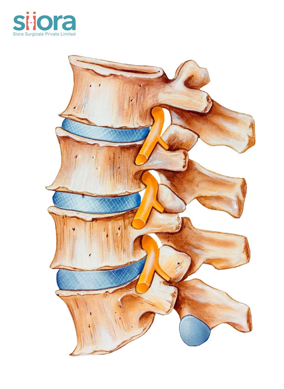 Lumbar Disc Prolapse — An Expert’s Guide - Siiora Surgical - Medium