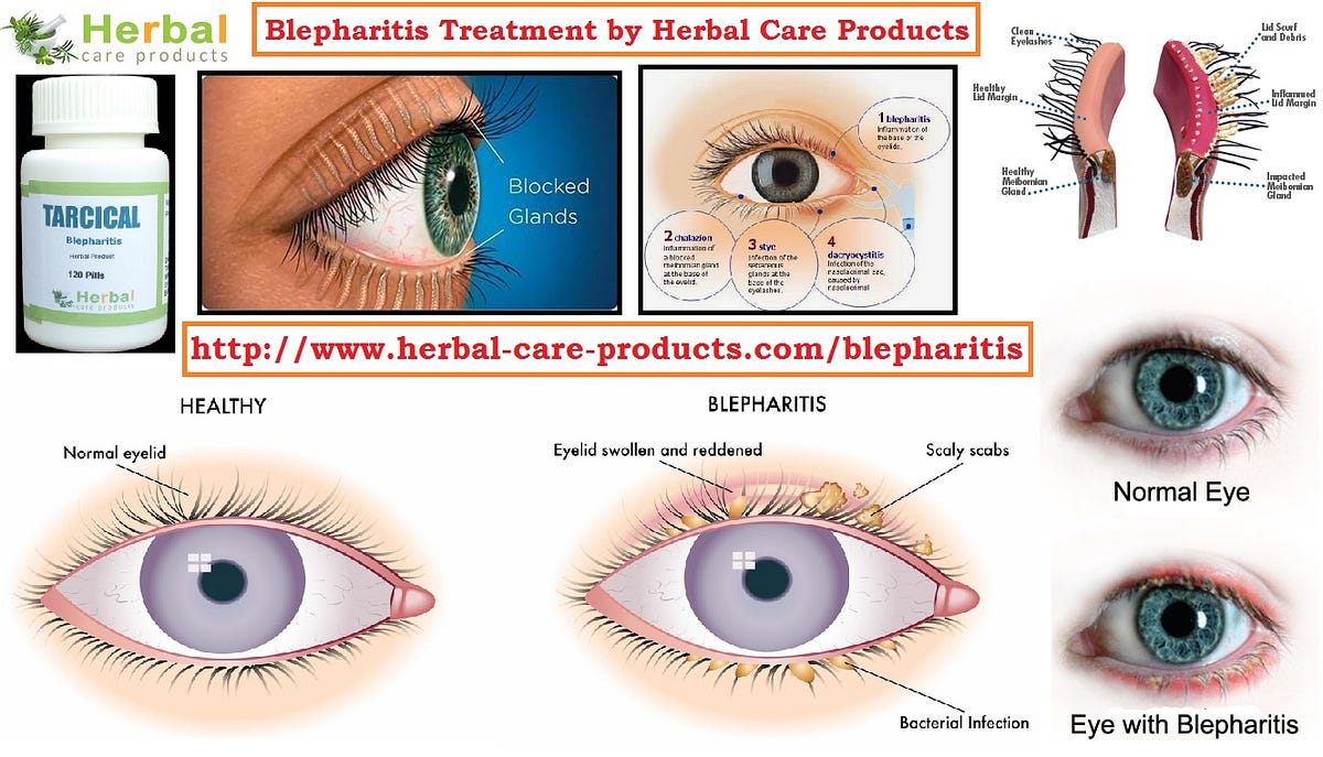 Blepharitis and Its Herbal Treatment | by Jennifer Lawrance | Medium