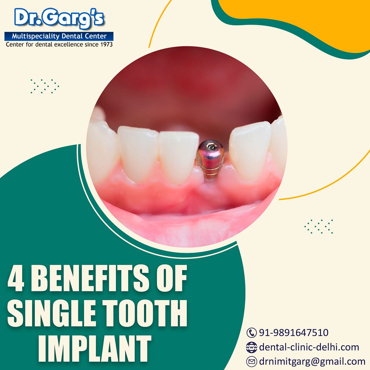 4 Benefits of Single Tooth Implant | by Nimit Garg | Medium