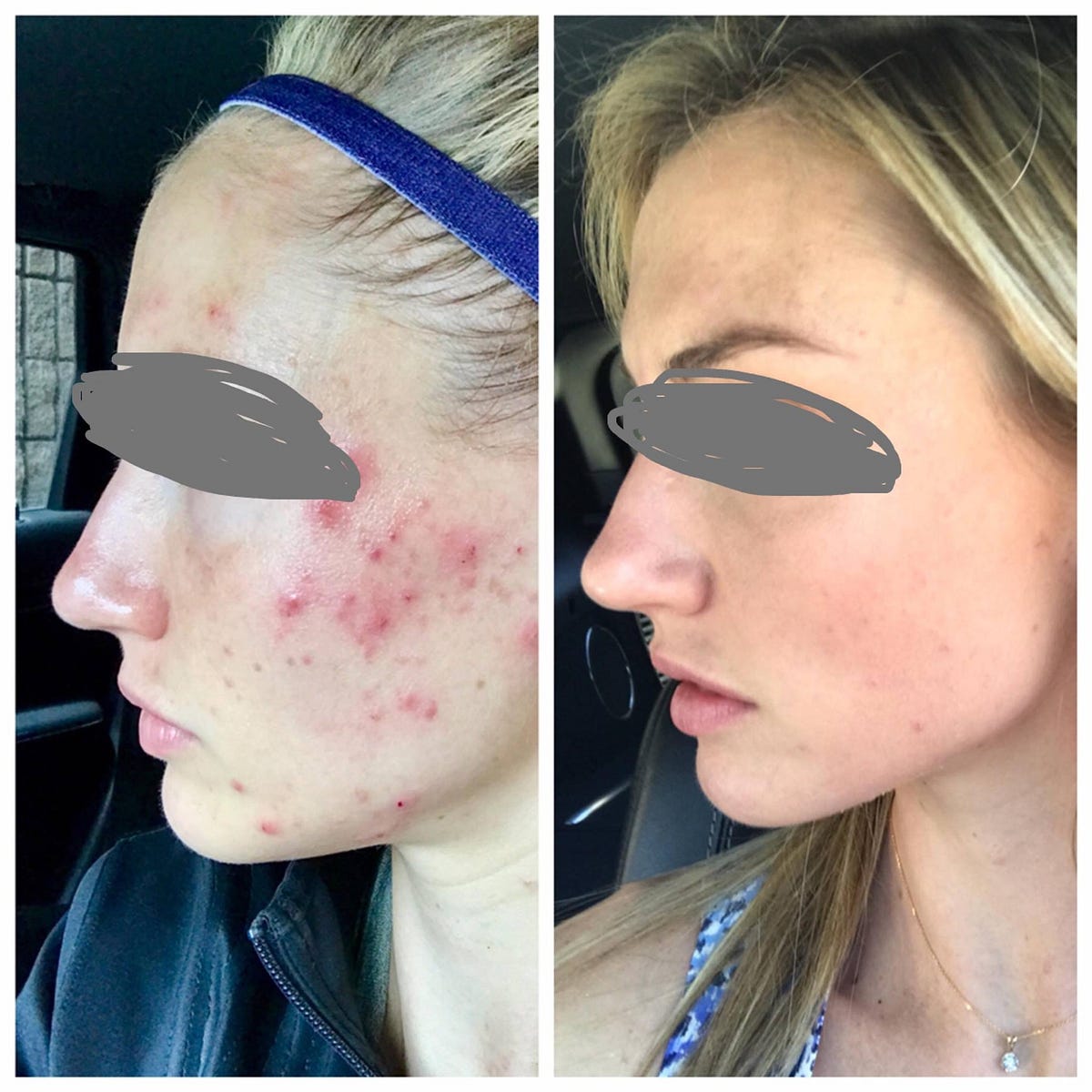 Acne facial with Retin A peel.. Before and three weeks after… | by ...