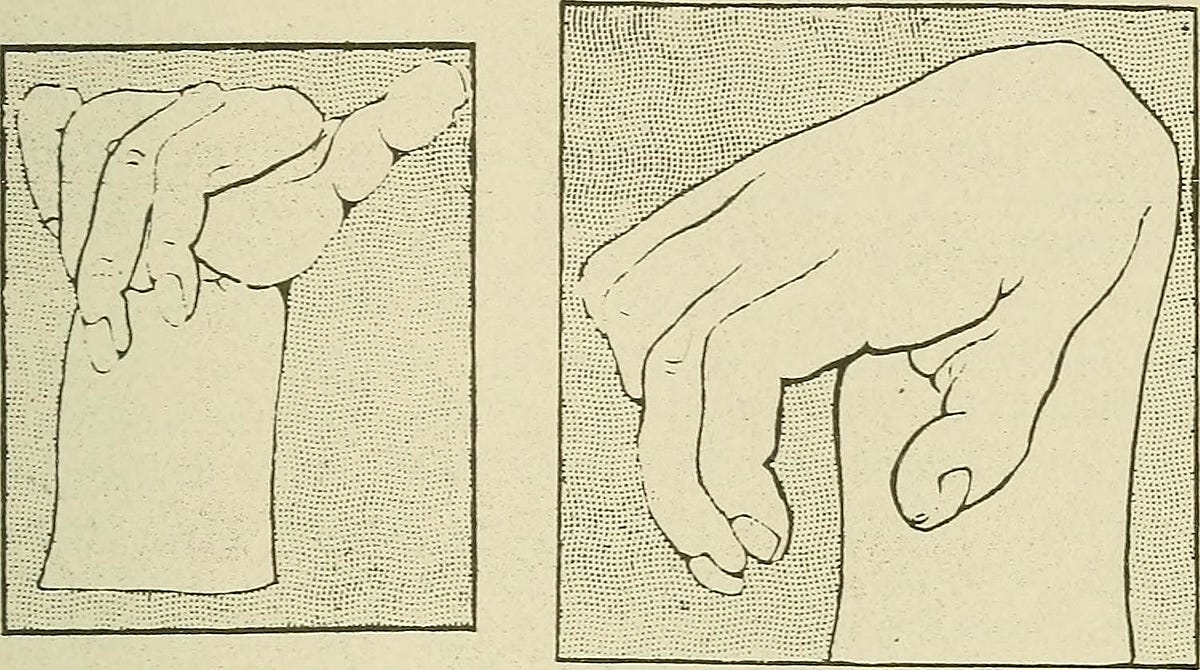 I Woke Up And Could Not Move My Fingers | by Christine Stevens | The ...