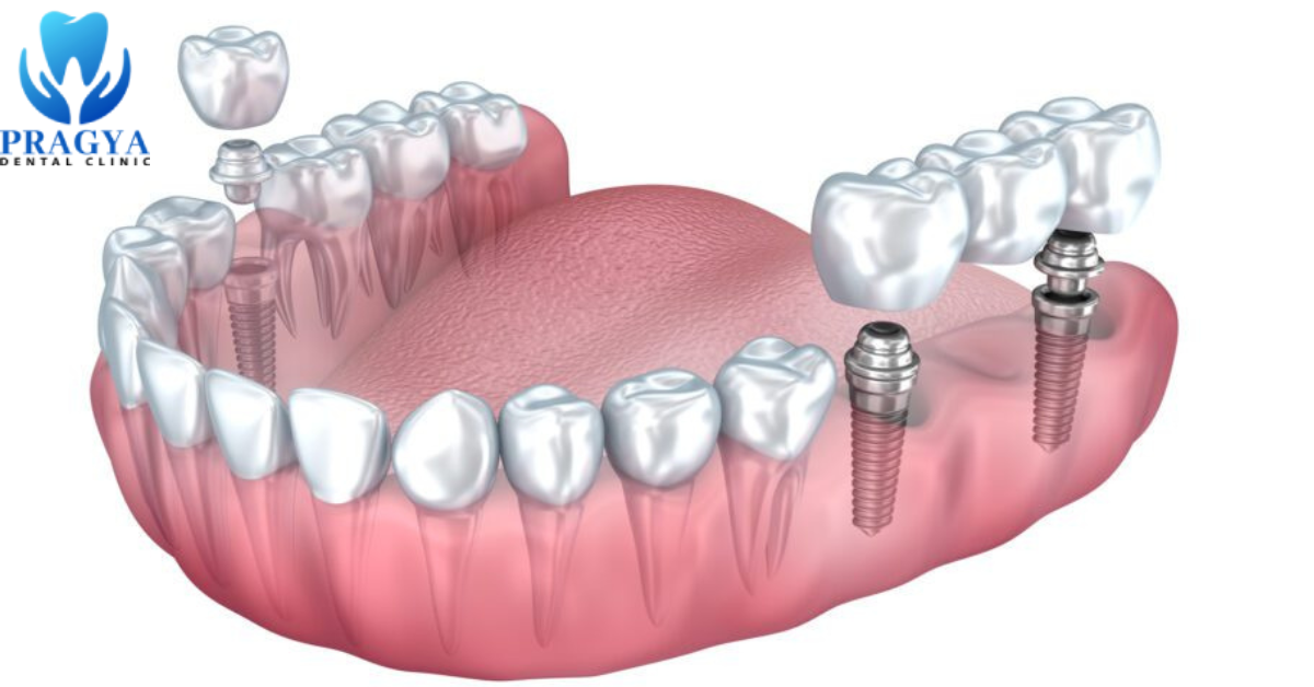 Best Dental Implant in Greater Noida I Pragya Dental Clinic - Dentist ...