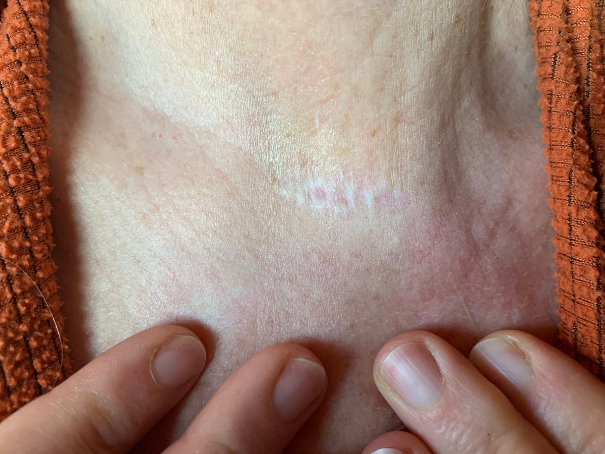 Is your scar healthy?. How to improve the look and feel of… | by Andie ...