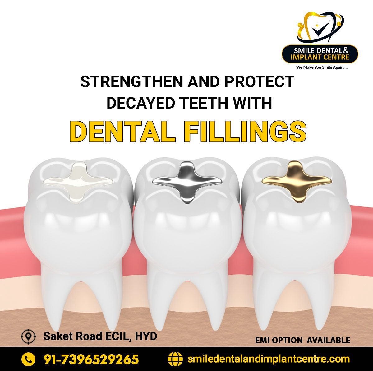 How long does Tooth Filling Last? | Tooth Filling Cost in Secunderabad ...