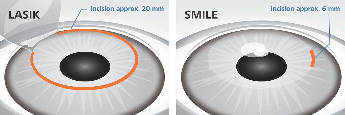 SMILE VISION CORRECTION IS HERE. The best 30 seconds of your year ...