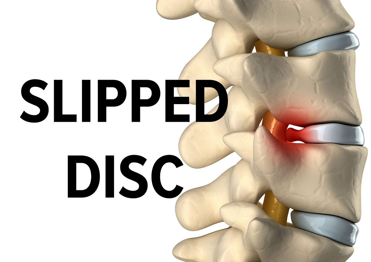 Exercise Safely And Successfully With A Slipped Disc | by Dr Himanshu ...