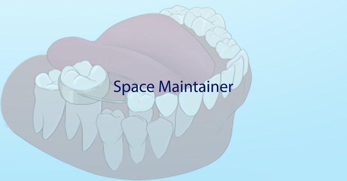 Space maintainers. In order to help children maintain the… | by ...