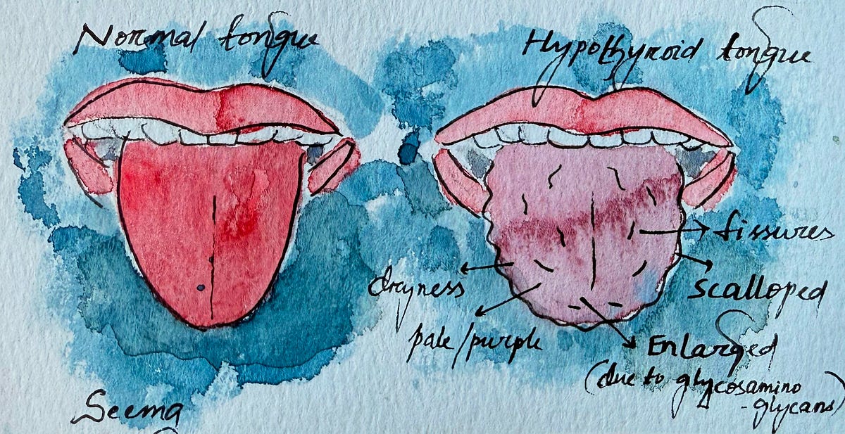 Hypothyroidism and Macroglossia. The hormonal cause of enlarged tongue ...