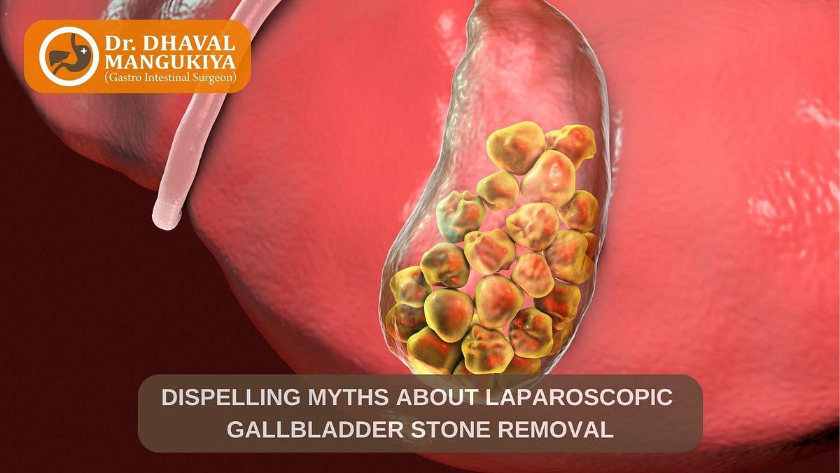 Dispelling Myths About Laparoscopic Gallbladder Stone Removal From The ...