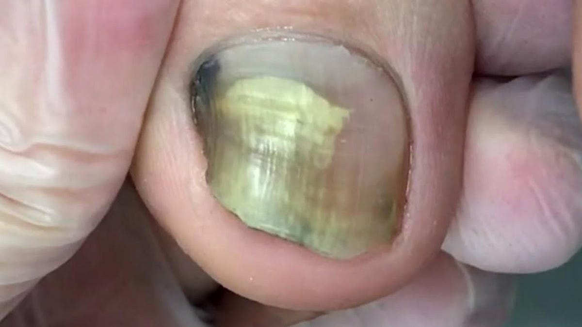 REAL cause of Toenail fungus and How to Eliminate it in less than 14 ...