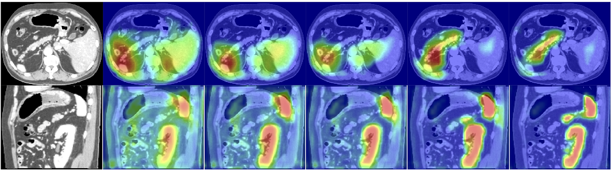 Review: Attention U-Net — Learning Where to Look for the Pancreas (Biomedical Image Segmentation ...