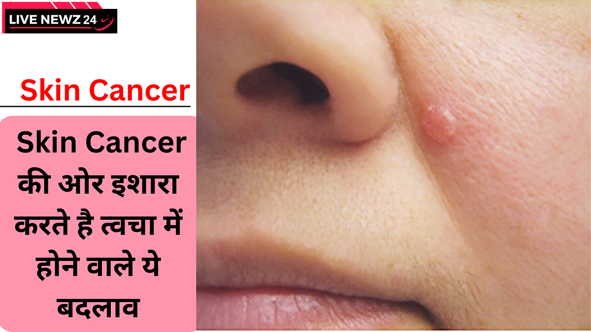 Skin Cancer. Skin Cancer: कारण, लक्षण, और उपचार | by Svibhor | Apr ...