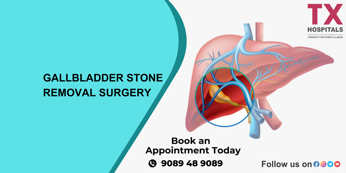 Unlocking Gallbladder Stone Removal in Hyderabad: Hospitals, Surgeons ...